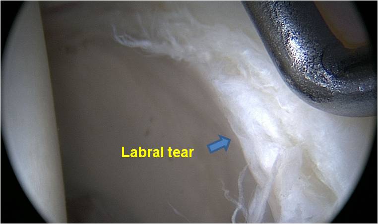 Hip arthroscopy for an 18 year old male baseball player with FAI - John ...